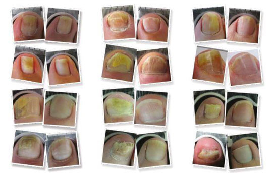 Lunula™ – Pop Podiatry